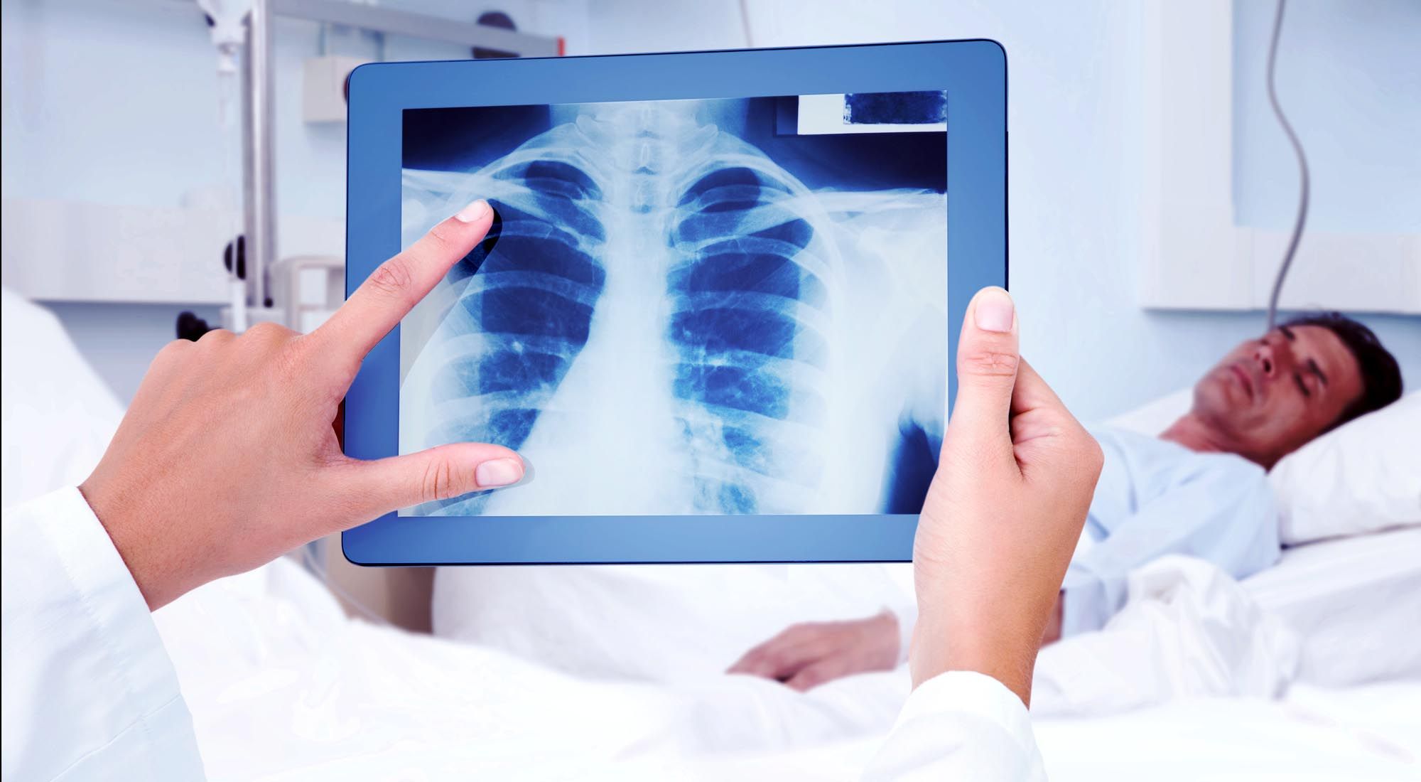 Tuberculosis: cómo se contagia y cuáles son los síntomas | Perfil