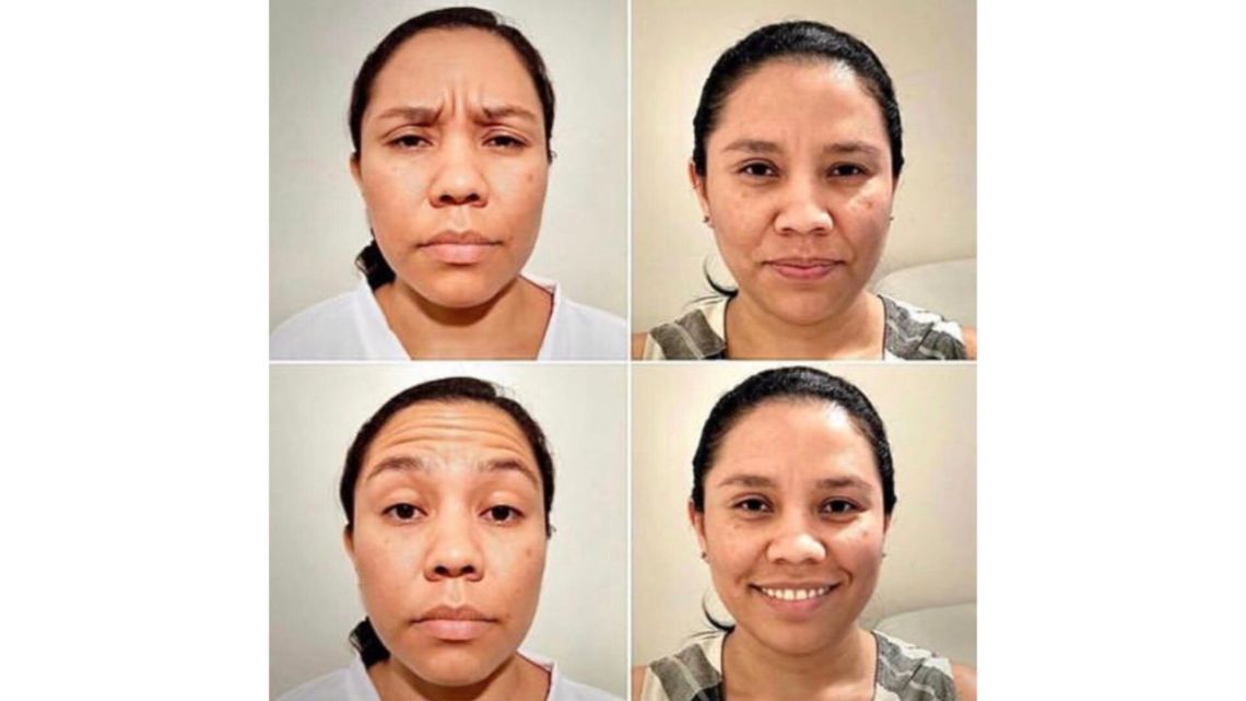 Centro Médico List: conociendo el botox | Caras