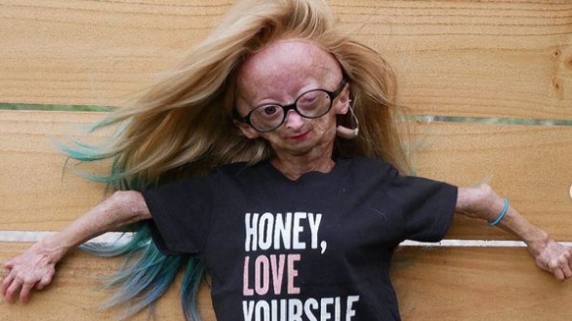 Murió Adalia Rose La Famosa Youtuber Que Padecía Del Síndrome De